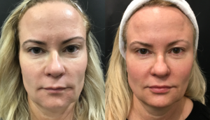 PDO Threads Chicago | RL Center for Cosmetic Surgery & Medspa